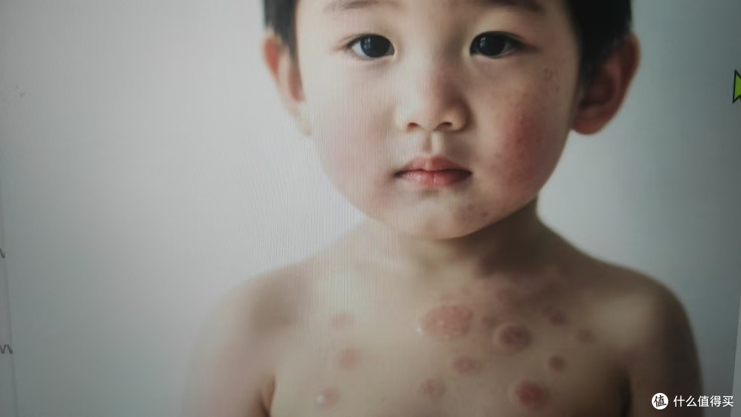 小孩出水痘怎样治疗_婴儿护理用品_什么值得买